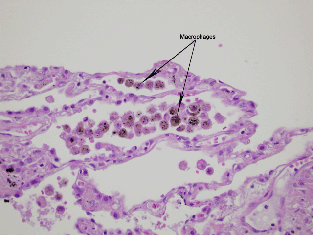 Chronic Inflammation