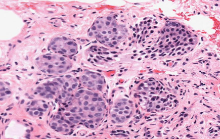 High Yield Breast Pathology: Lobular Breast Proliferation & Breast ...