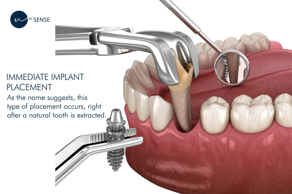 All about Dental Implants |Dr. Purav Mehta | Dental Care