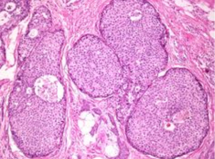 High Yield Breast Pathology: Lobular Breast Proliferation & Breast ...