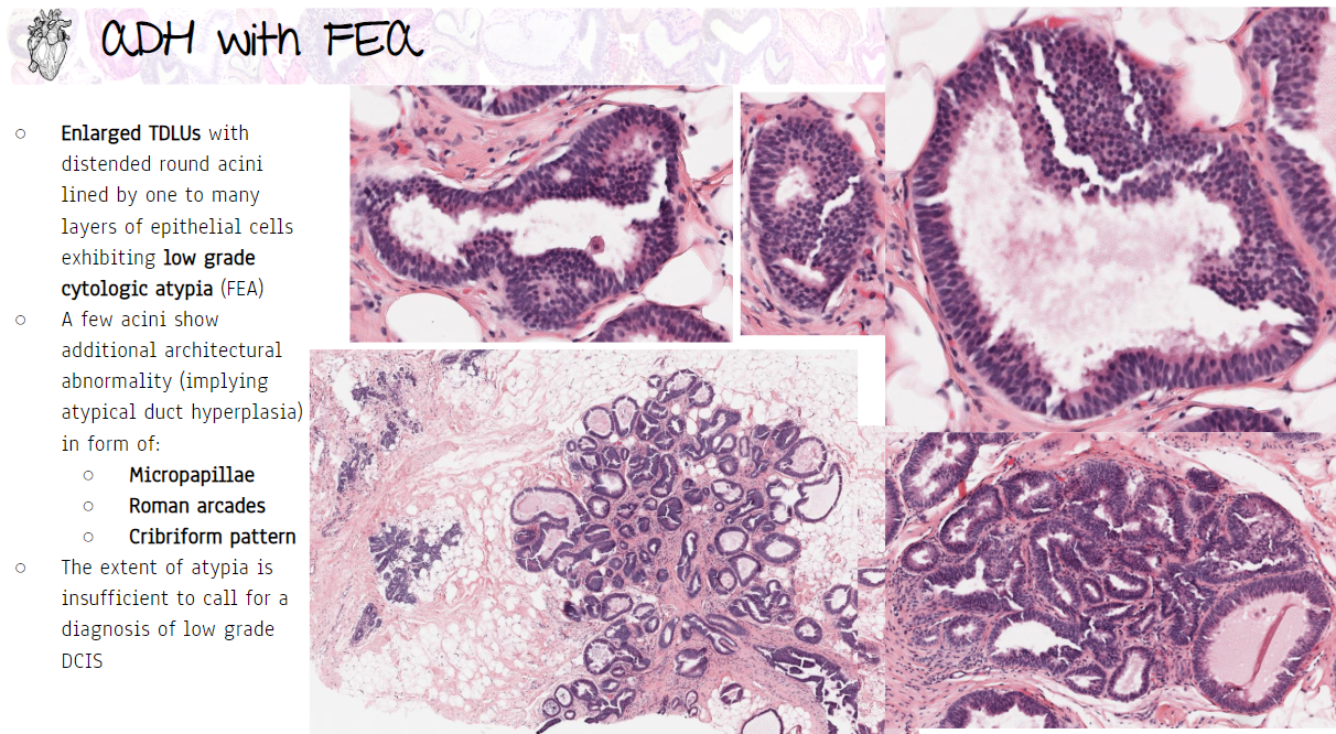 High Yield Breast Pathology: Atypical Ductal Hyperplasia (ADH)