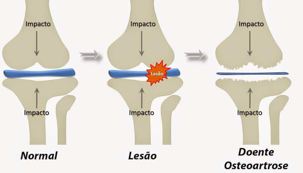 Osteoartrite (artrose)