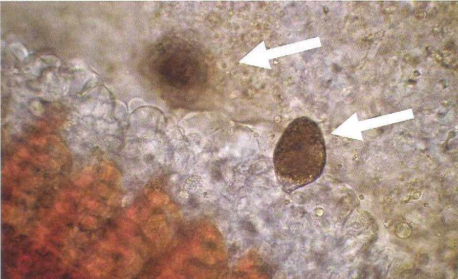 Parasit dan Infeksi Sekunder