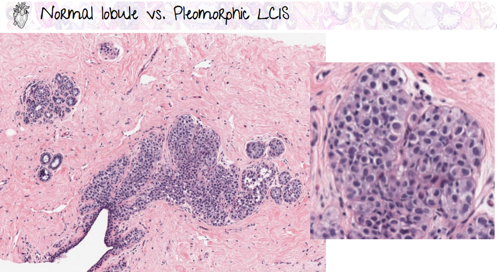 High Yield Breast Pathology: Lobular Breast Proliferation & Breast ...