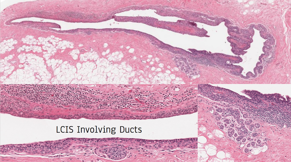 High Yield Breast Pathology: Lobular Breast Proliferation & Breast ...