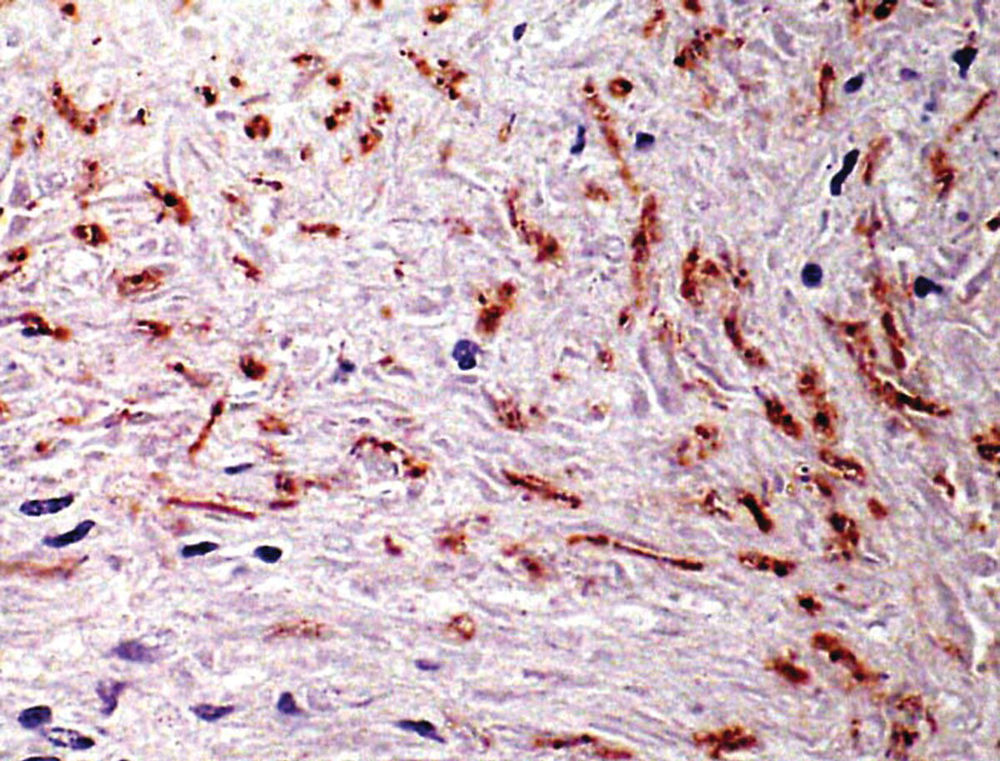 Gangrenous Dermatitis