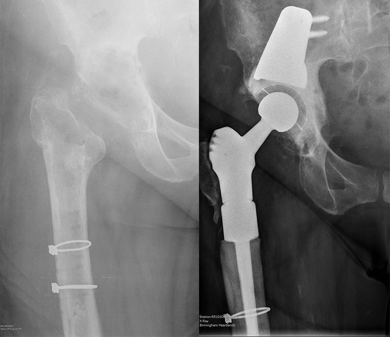 Patients: LIFE AFTER A HIP INFECTION