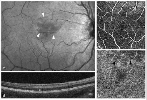 Artigo PAMM e AMN | Retina Grand Rounds