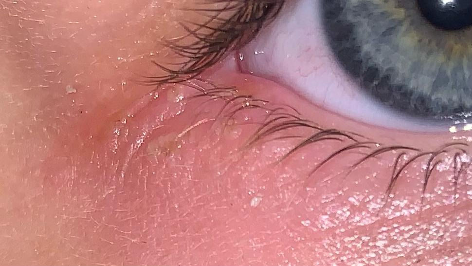 Augenherpes? ist dies Herpes? Es sind kl. Bläschen und es juckt und tut ...