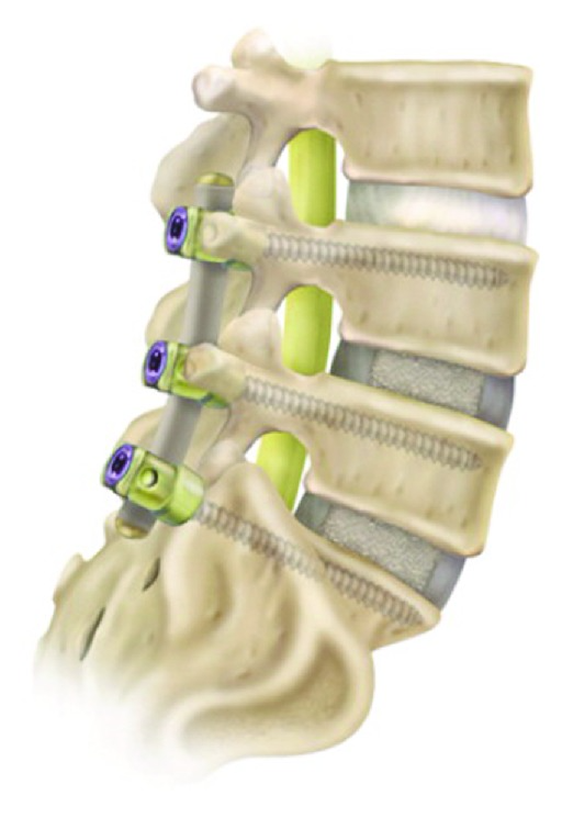 Medtronic Sofamor Danek CD HORIZON LEGACY Pedicle Screw System. ROD ...