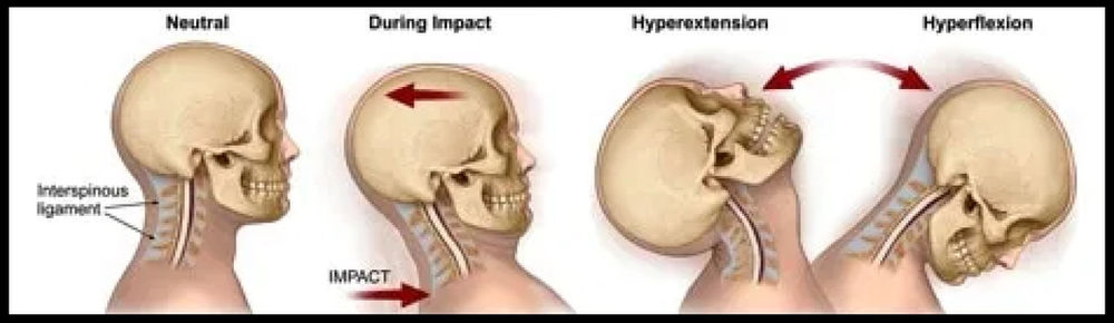 What does whiplash mean?