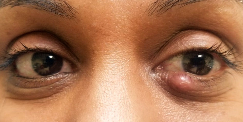 How do I treat an eye lid bump, lump or swelling?