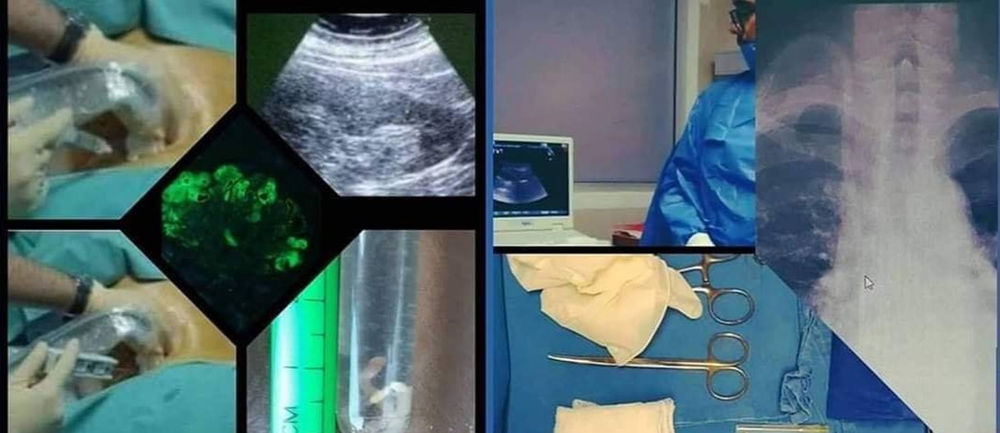 NEFROPATIA POR IGA (ENFERMEDAD DE BERGER): INFORMACION BASICA