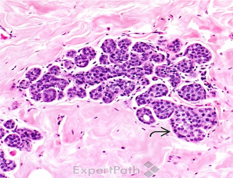 High Yield Breast Pathology: Lobular Breast Proliferation & Breast Cancer- ALH, LCIS & ILC