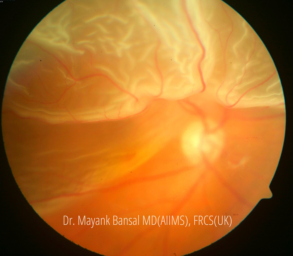Eye Floaters & Retinal Detachment