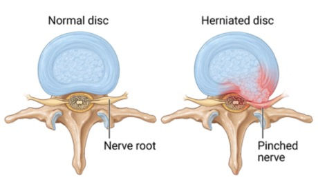 Disc Herniation and Sciatica Explained with a Quick Test! Why Bending ...