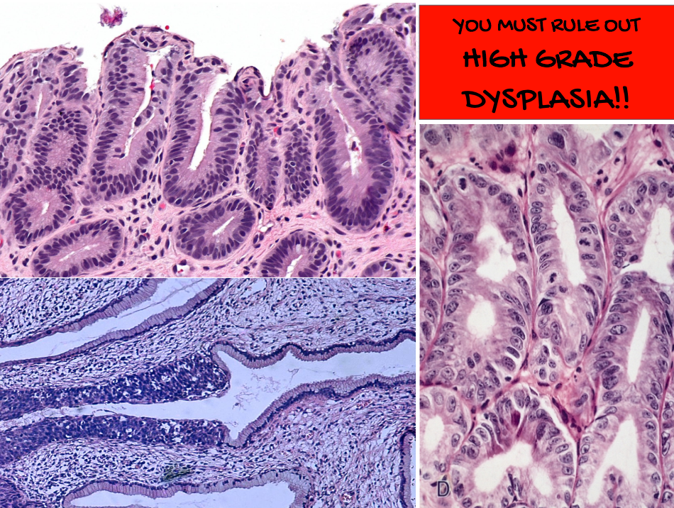 High Yield GI Pathology- Esophagus- GERD & Barrett Metaplasia