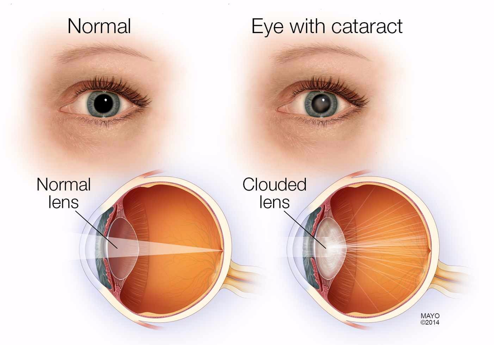 Cataracts