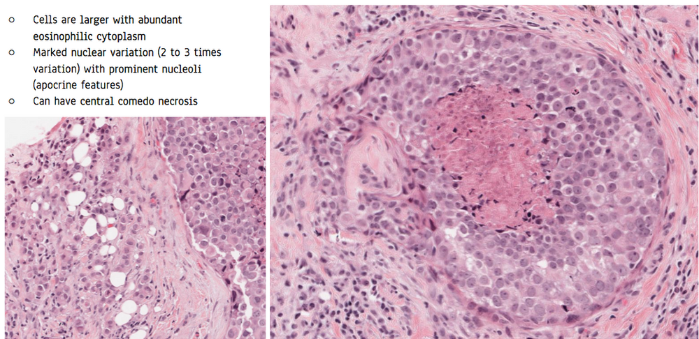 High Yield Breast Pathology: Lobular Breast Proliferation & Breast ...