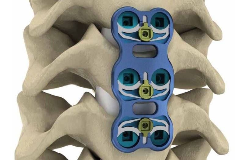 Stryker AVIATOR®. Cervical Plate & Screw System. PLATE. One-Level. Cat ...