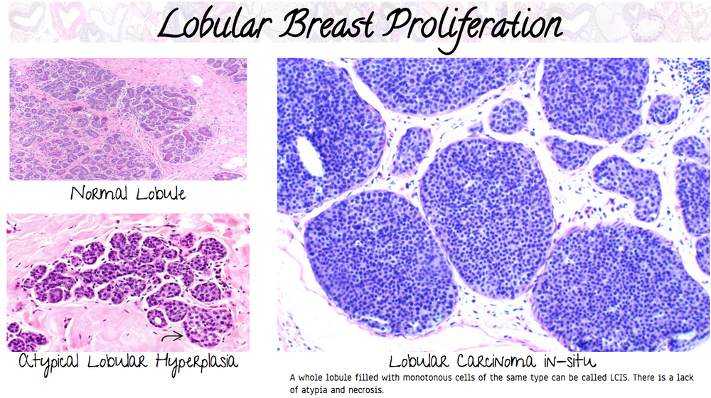 High Yield Breast Pathology: Lobular Breast Proliferation & Breast ...