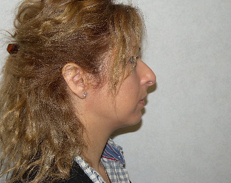 Rhinoplasty Photos | Neil Bulstrode