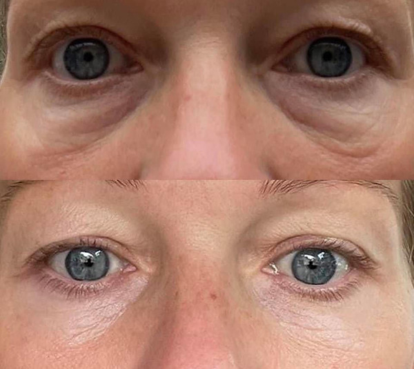 SKIN BOOSTERS | Gloss