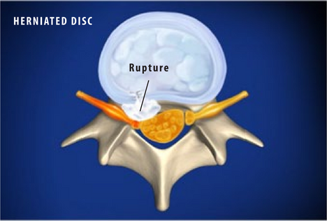 Lumbar Radiculopathy
