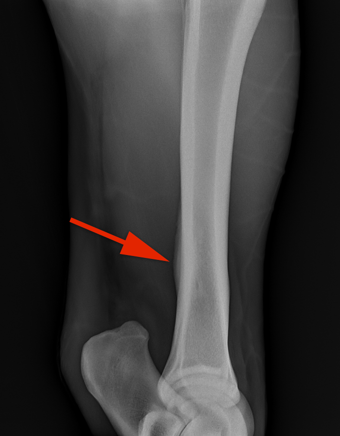 FATIGUE FRACTURES OF TIBIA