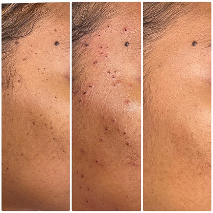 Dermatosis Papulosa Nigra (DPN) Treatments | Brave Skin Remedy