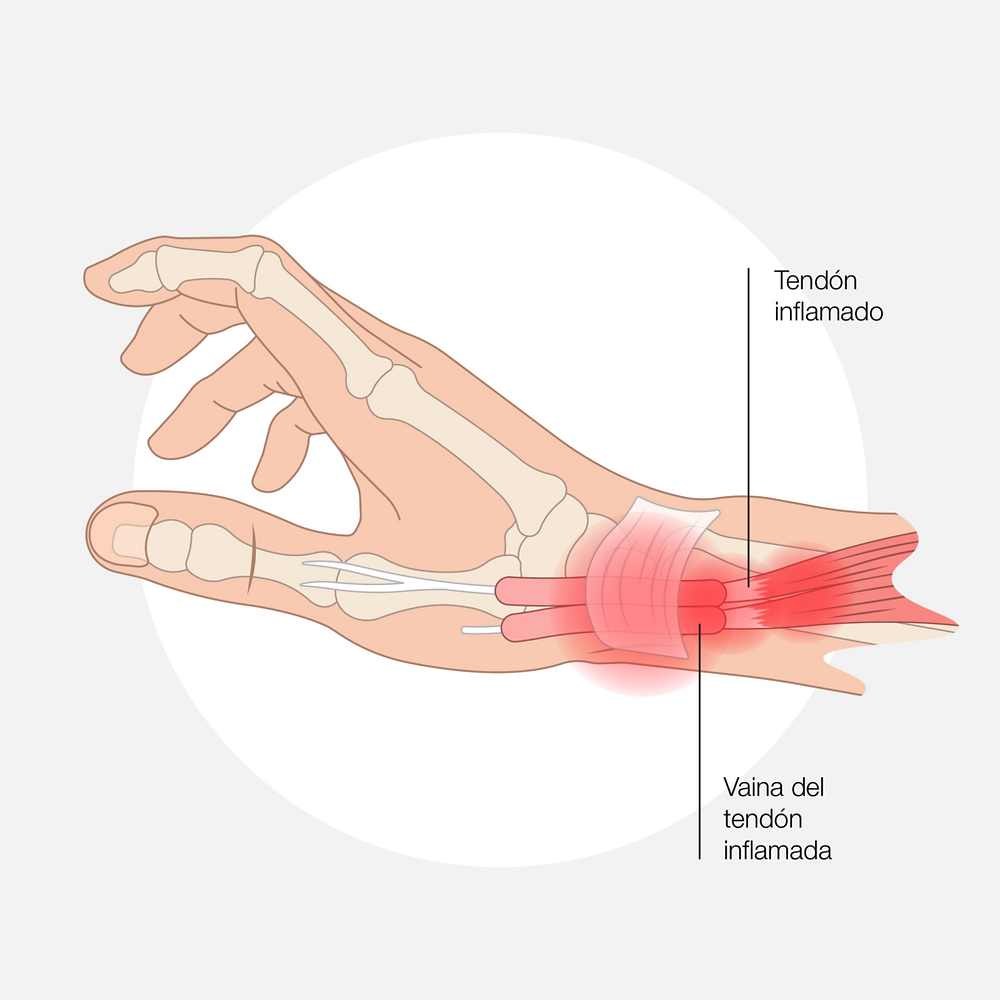 TENDINITIS: ¿QUÉ SON? TRATAMIENTO Y PREVENCIÓN