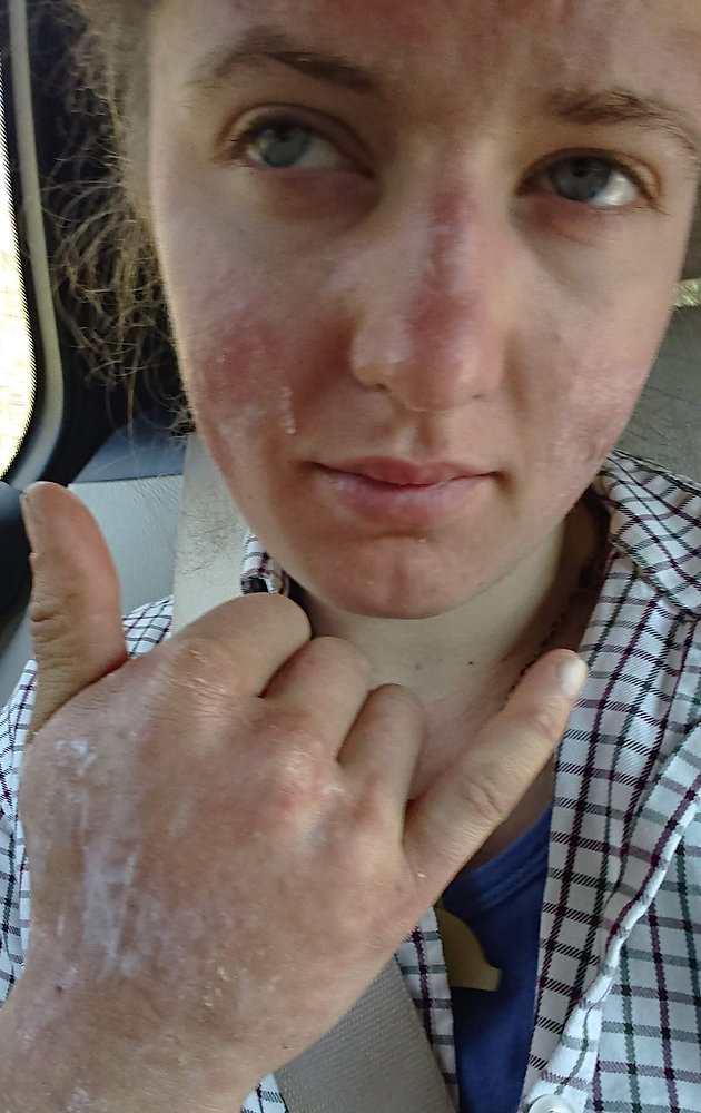 How I ended up with Chemical Blood Poisoning on a Farm, UK