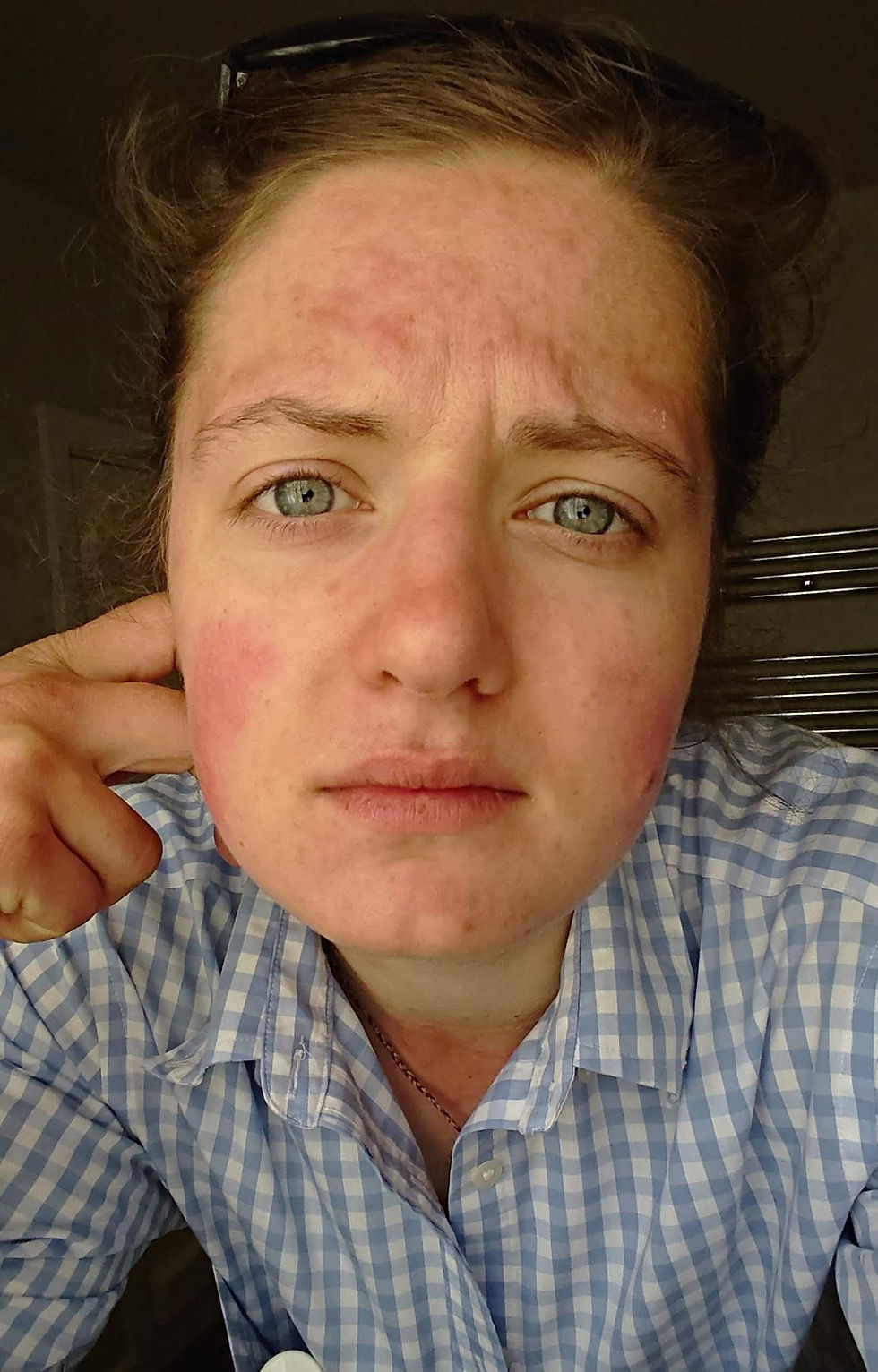 How I ended up with Chemical Blood Poisoning on a Farm, UK