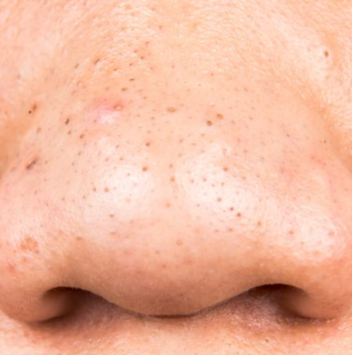 3 Pore Clogging Ingredients That Are Ruining Your Skincare Routine.