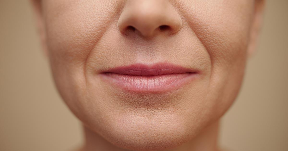 ¿Cómo se trata el surco nasogeniano hoy? Descubre las técnicas más ...