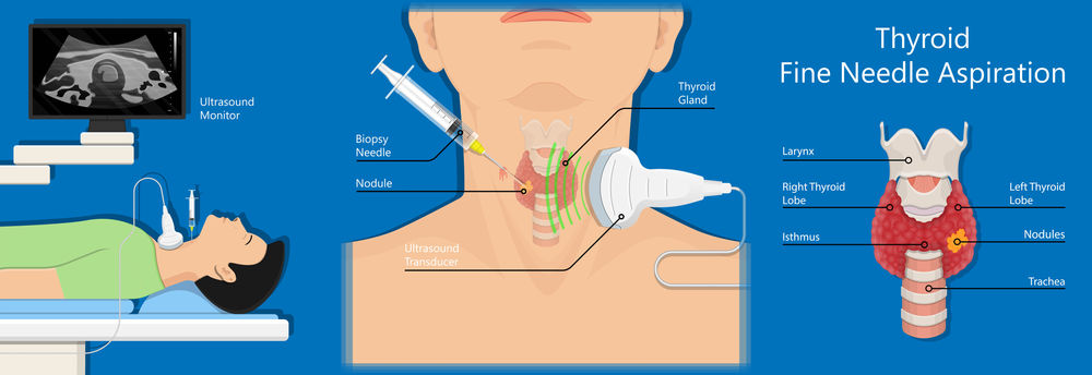 Thyroid Lumps & bumps: is it cancer Doc?
