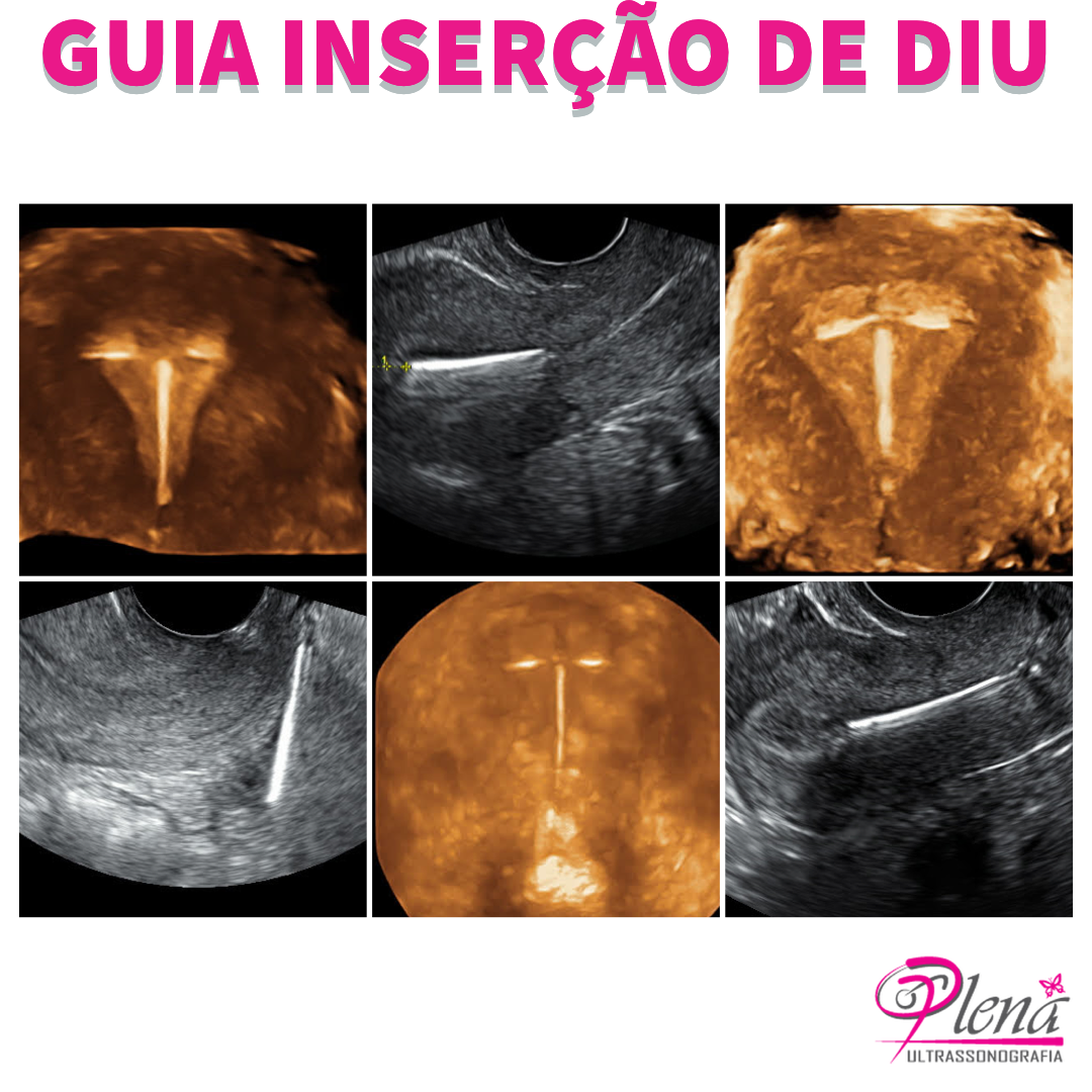 DOPPLER DA ARTÉRIA UTERINA RADIAL