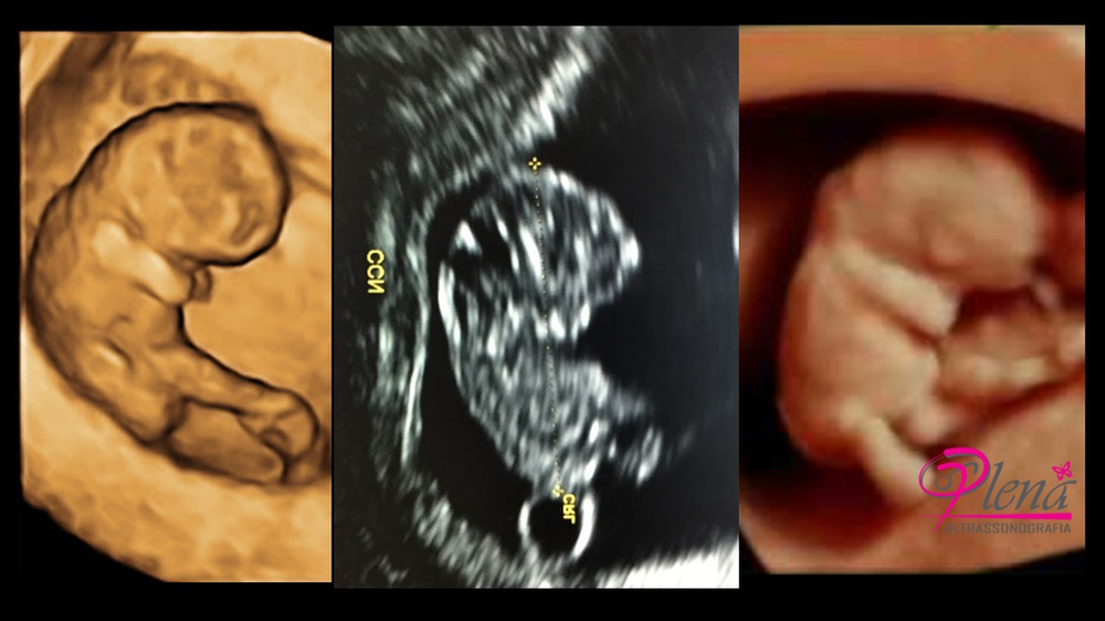 Ultrassom Transvaginal Obstétrico