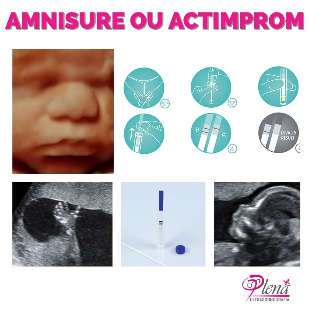 AMNISURE OU ACTIM PROM