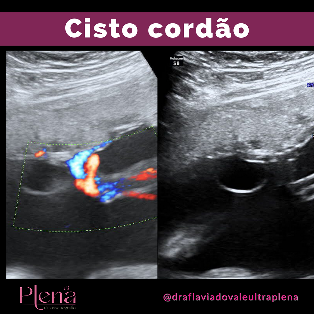 Cisto de cordão umbilical