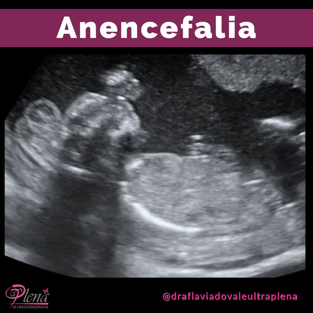 Anencefalia