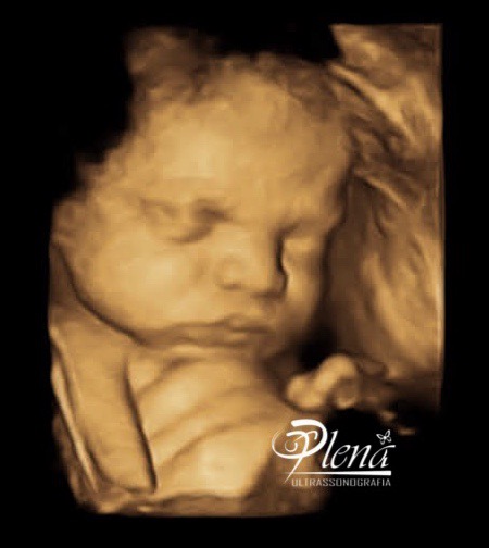 Qual é a diferença entre ultrassom 2D, 3D, 4D & 5D?