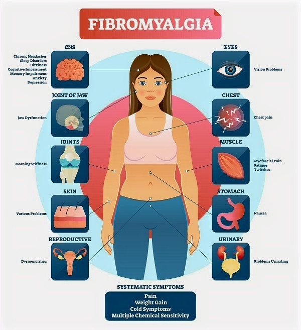 stroke and fibromyalgia