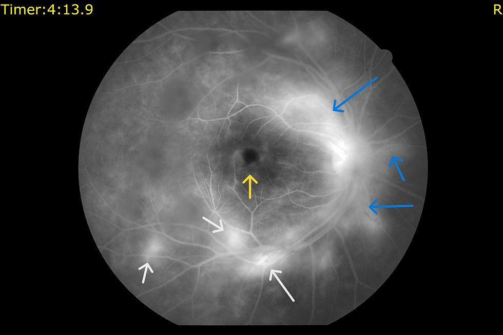Fibrous Proliferation / Pars Planitis