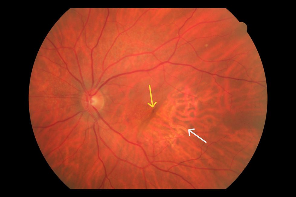 retina pigment epithelial tears