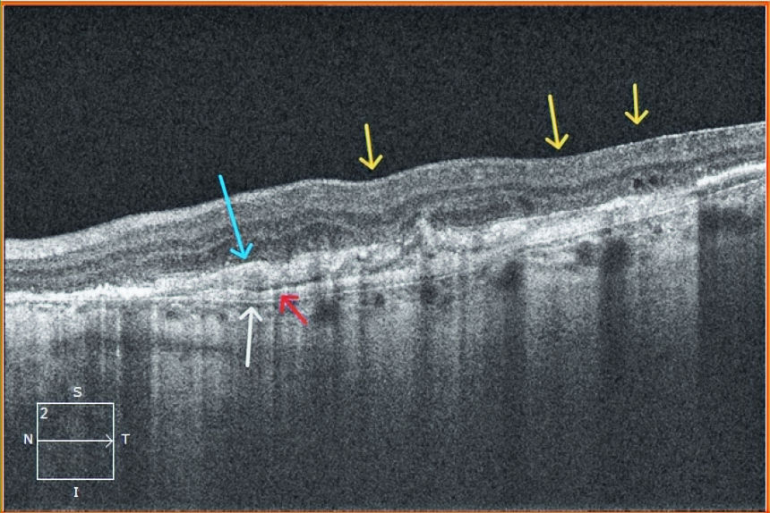 Triple layer sign, Double layer sign, SIRE, Ped - 1