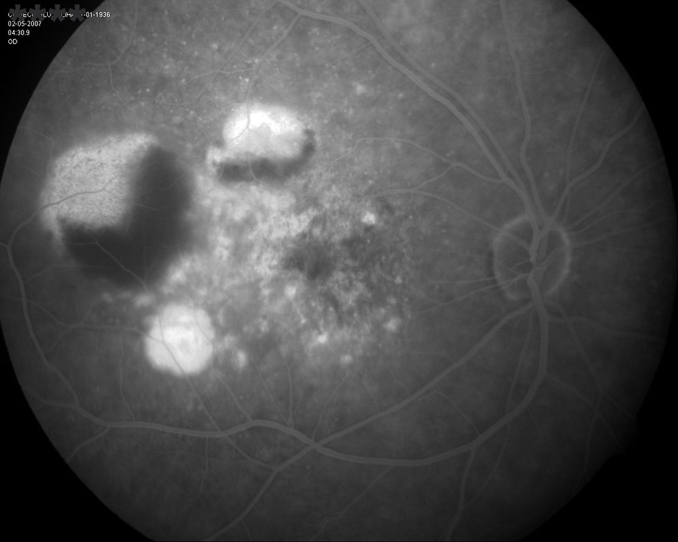 Idiopathic Polypoidal Choroidal Vasculopathy
