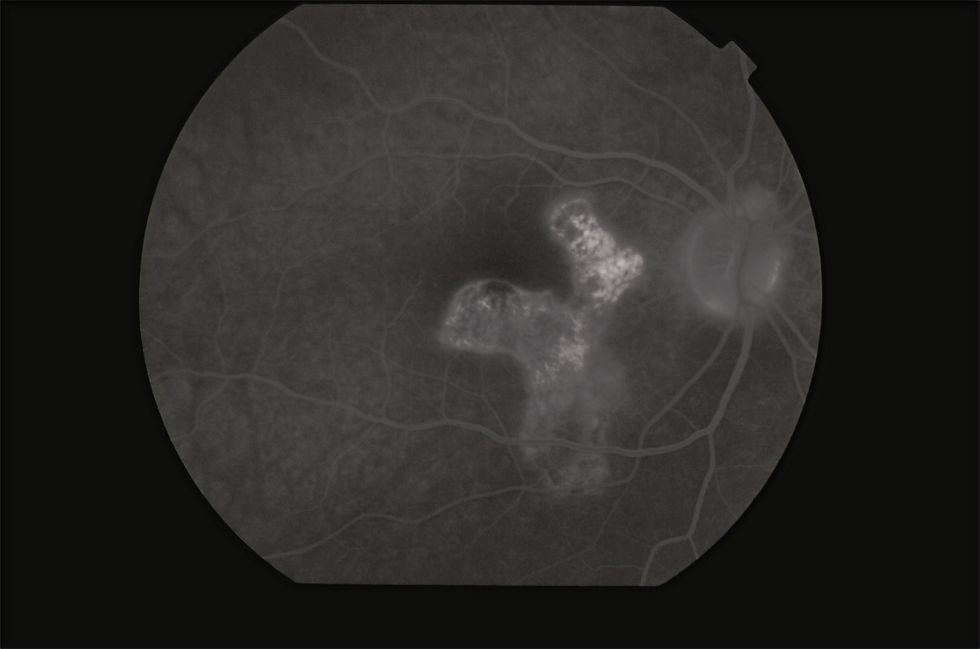 Macular Serpiginous Choroiditis