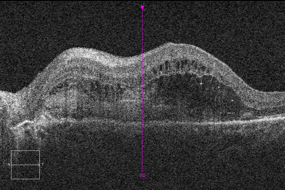 Peripapillary Choroidal Neovascularisation