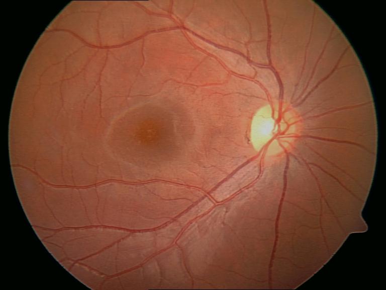 Dark choroidal sign / Stargardt disease
